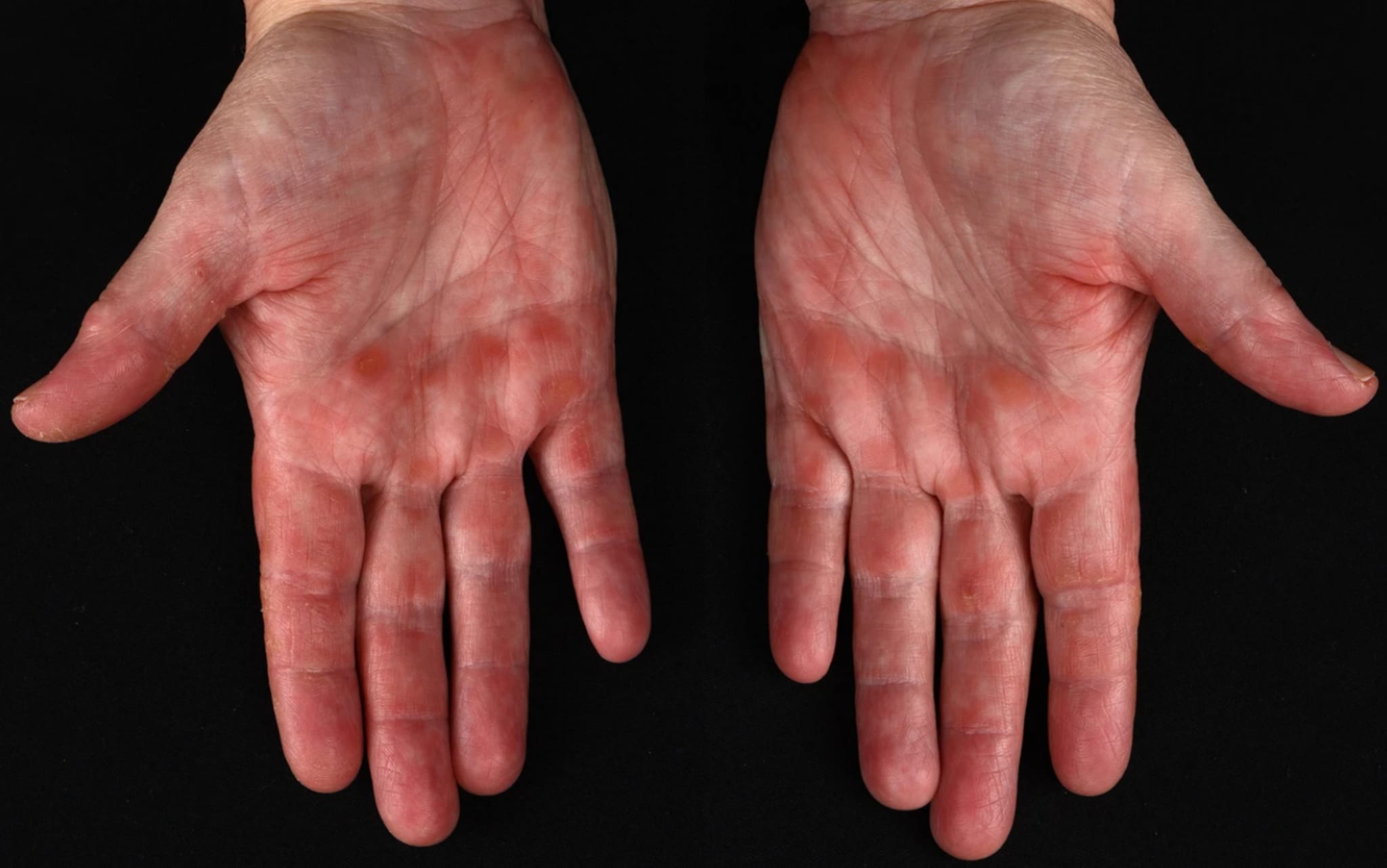 Warum sind diese palmaren Papeln ein Warnzeichen? - coliquio