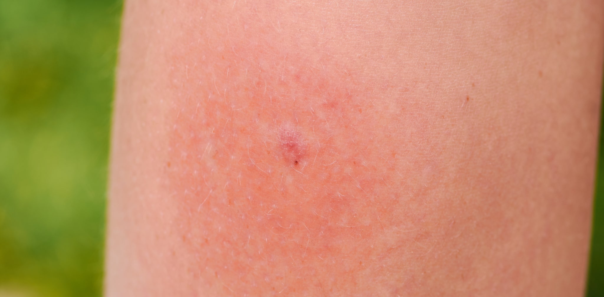 Therapie von Insektenbissen und -stichen