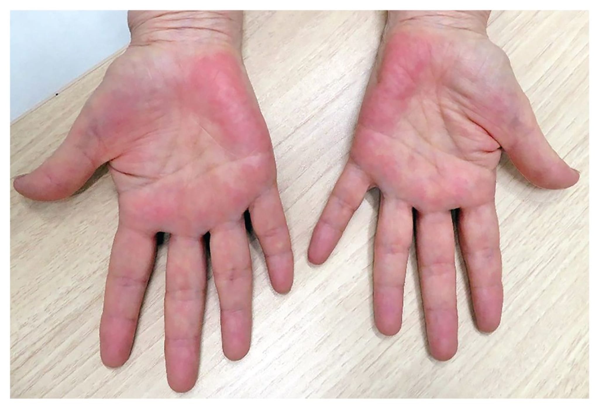 Bild der Woche: Rote Hände und brennender Körper - coliquio