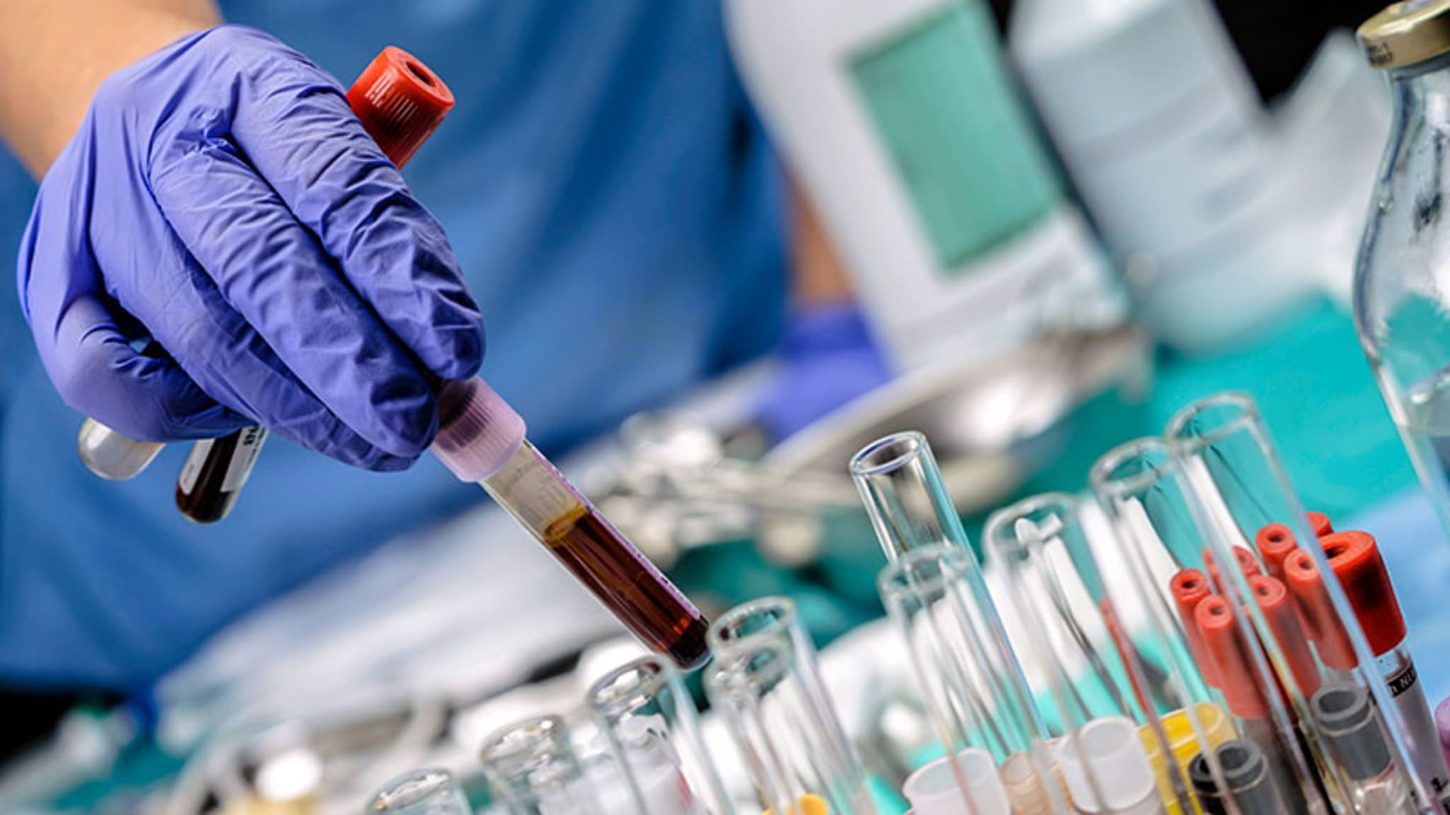 Biomarker für Synucleinopathien in Blut nachgewiesen