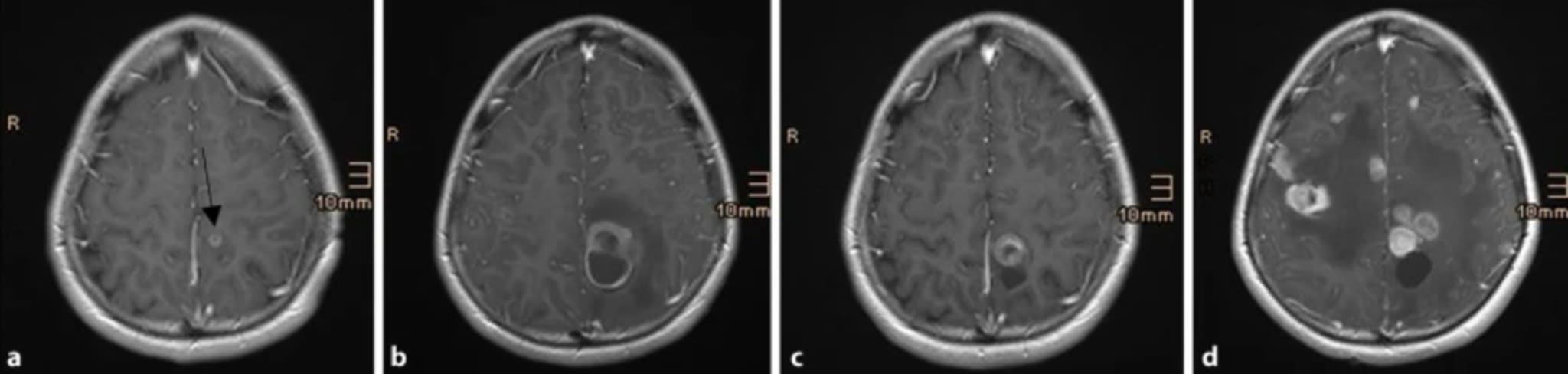Das juvenile Melanom: Fallbericht und Literaturübersicht