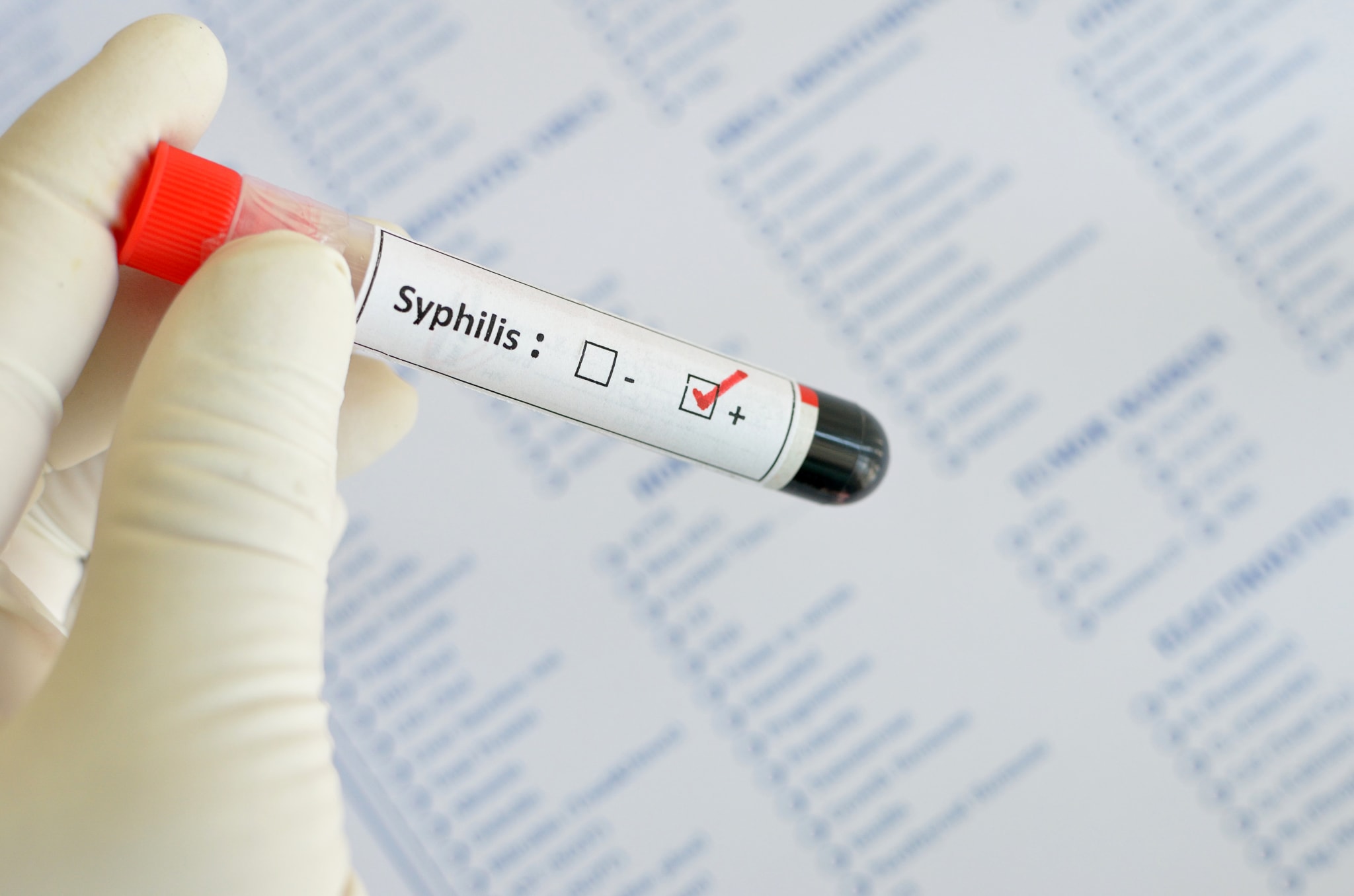 PCR-Tests verbessern Nachweis von Syphilis