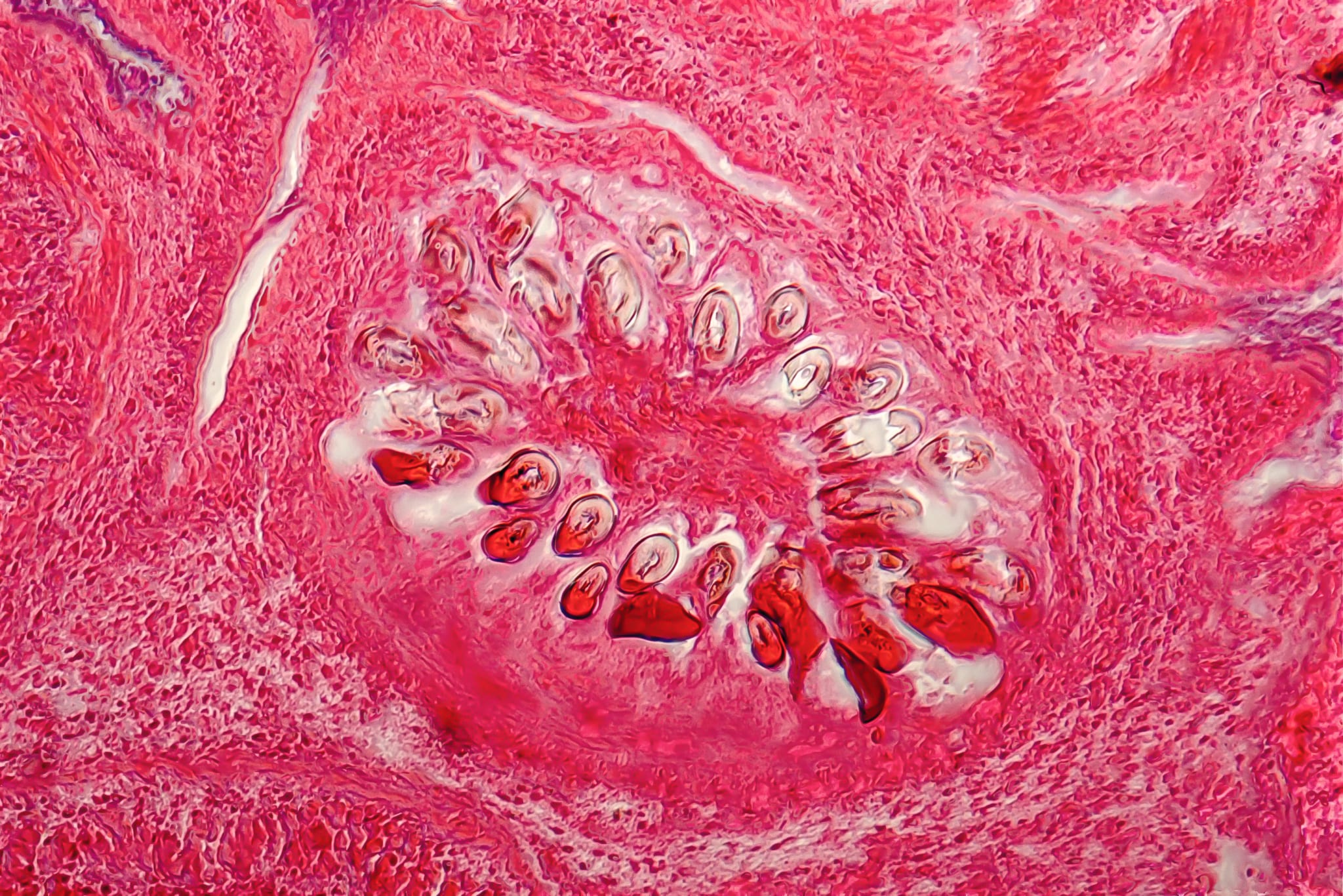 Echinokokkose E Granulosus Coliquio Echinokokkose E Granulosus Coliquio