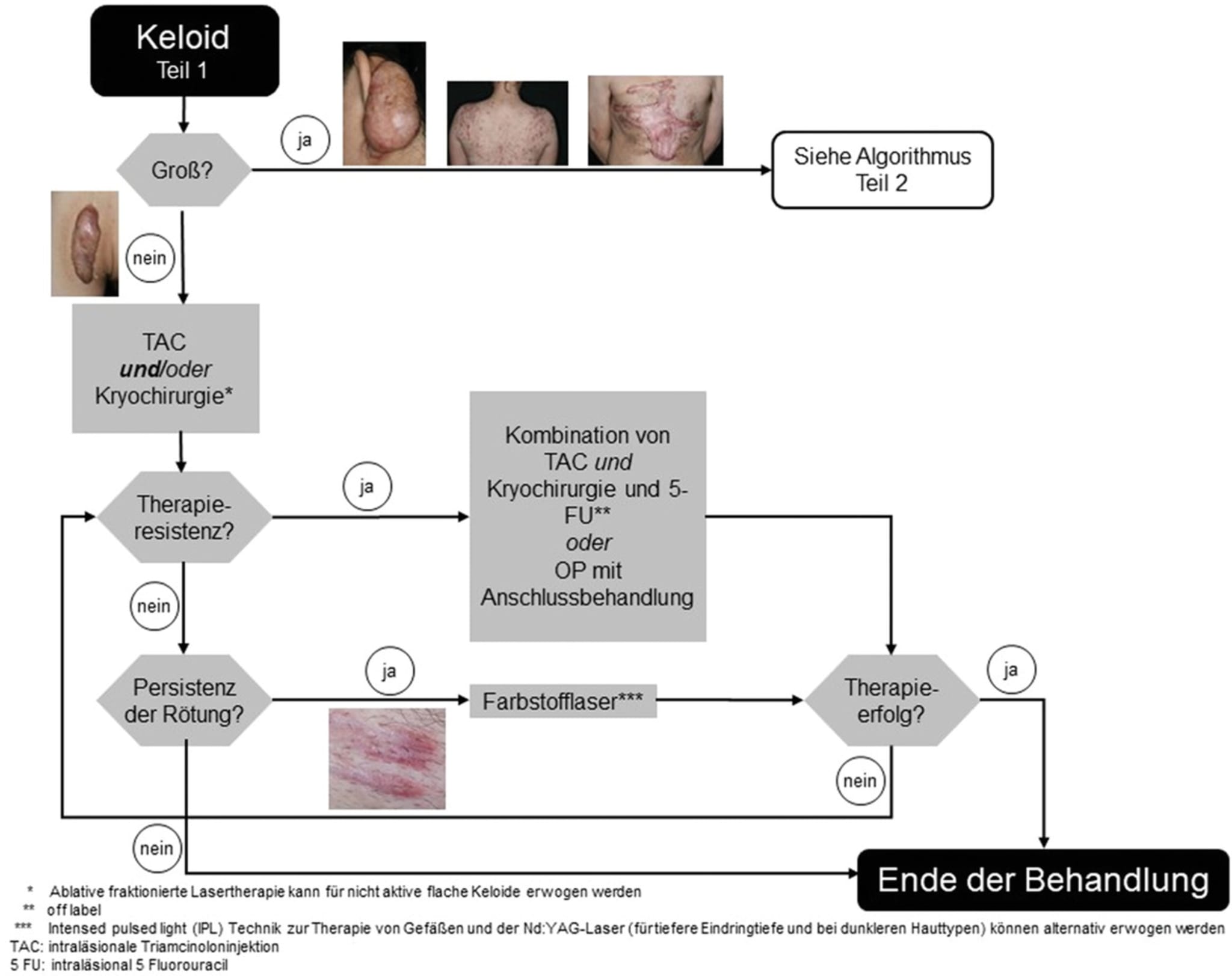 Keloide: Leitliniengerechte Behandlung im Überblick - coliquio