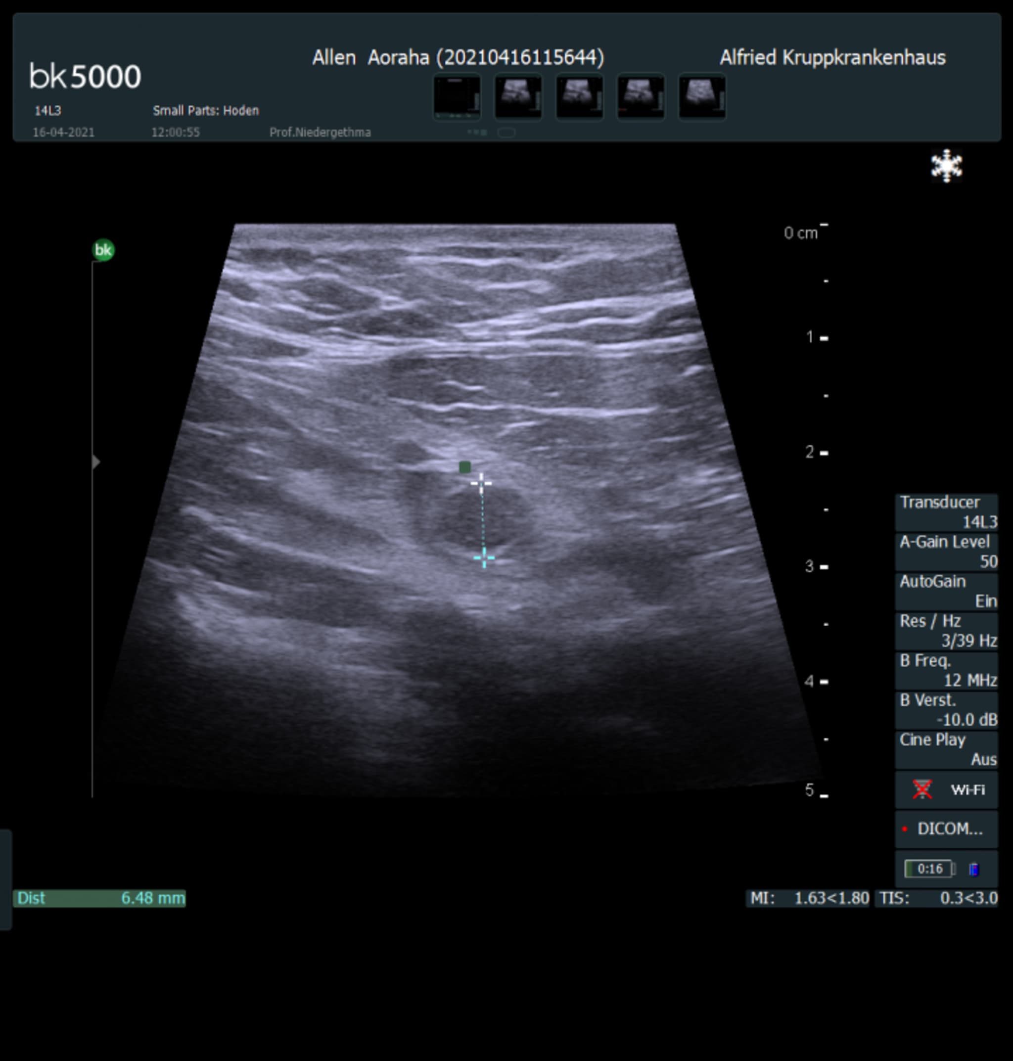 Durchführung einer laparoskopischen Appendektomie - coliquio