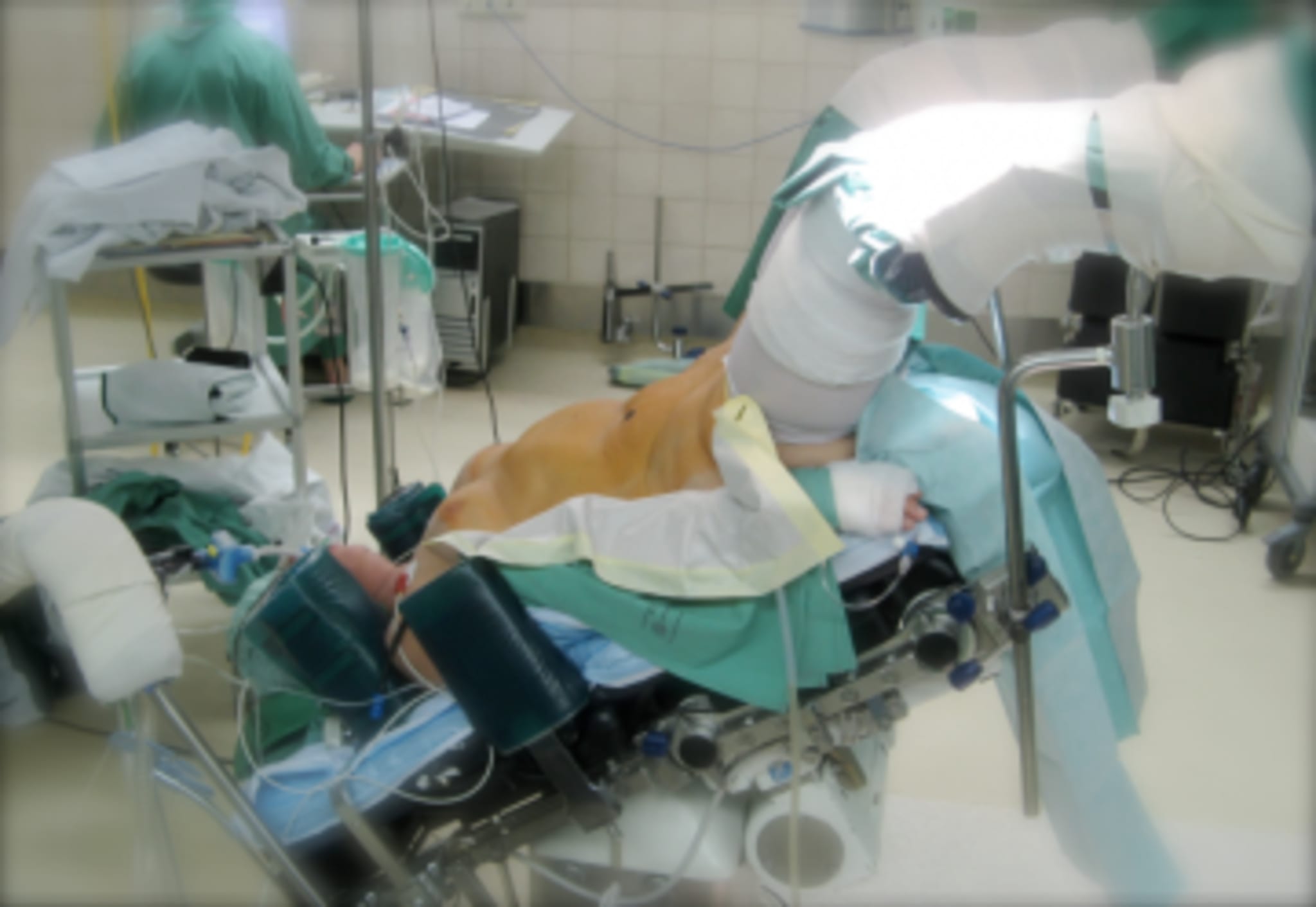 Durchführung einer laparoskopischen Sigmaresektion - coliquio