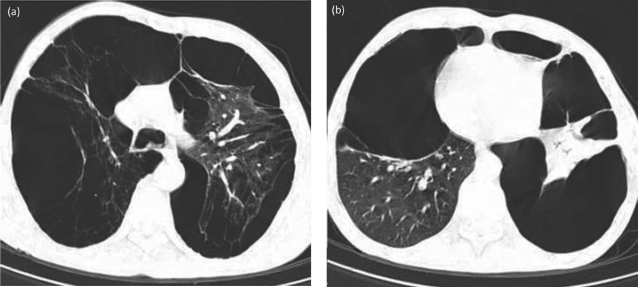 Die verschwindende Lunge - coliquio