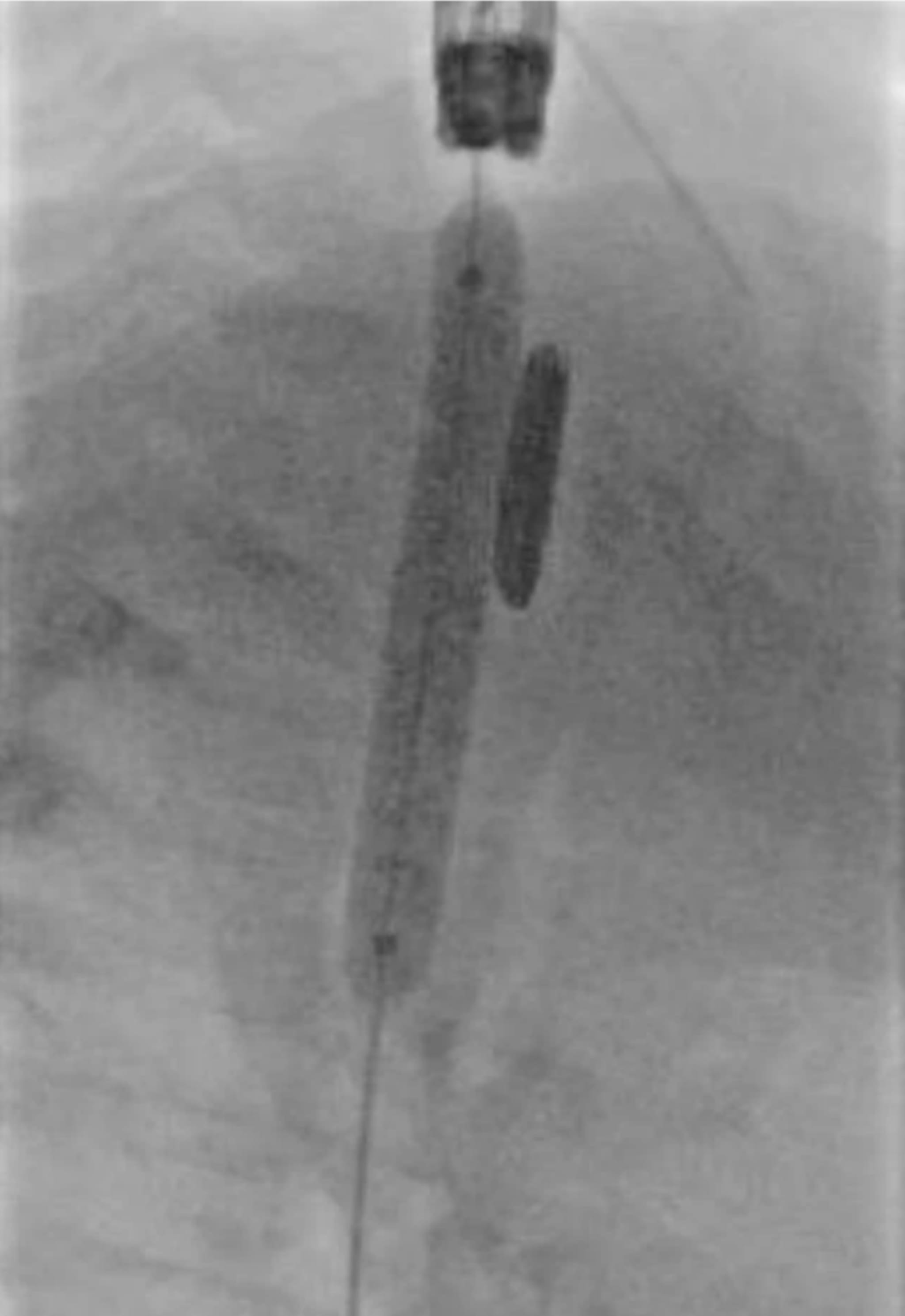 Verschluckte Knopfzellen: Spannung für alle Beteiligten - coliquio