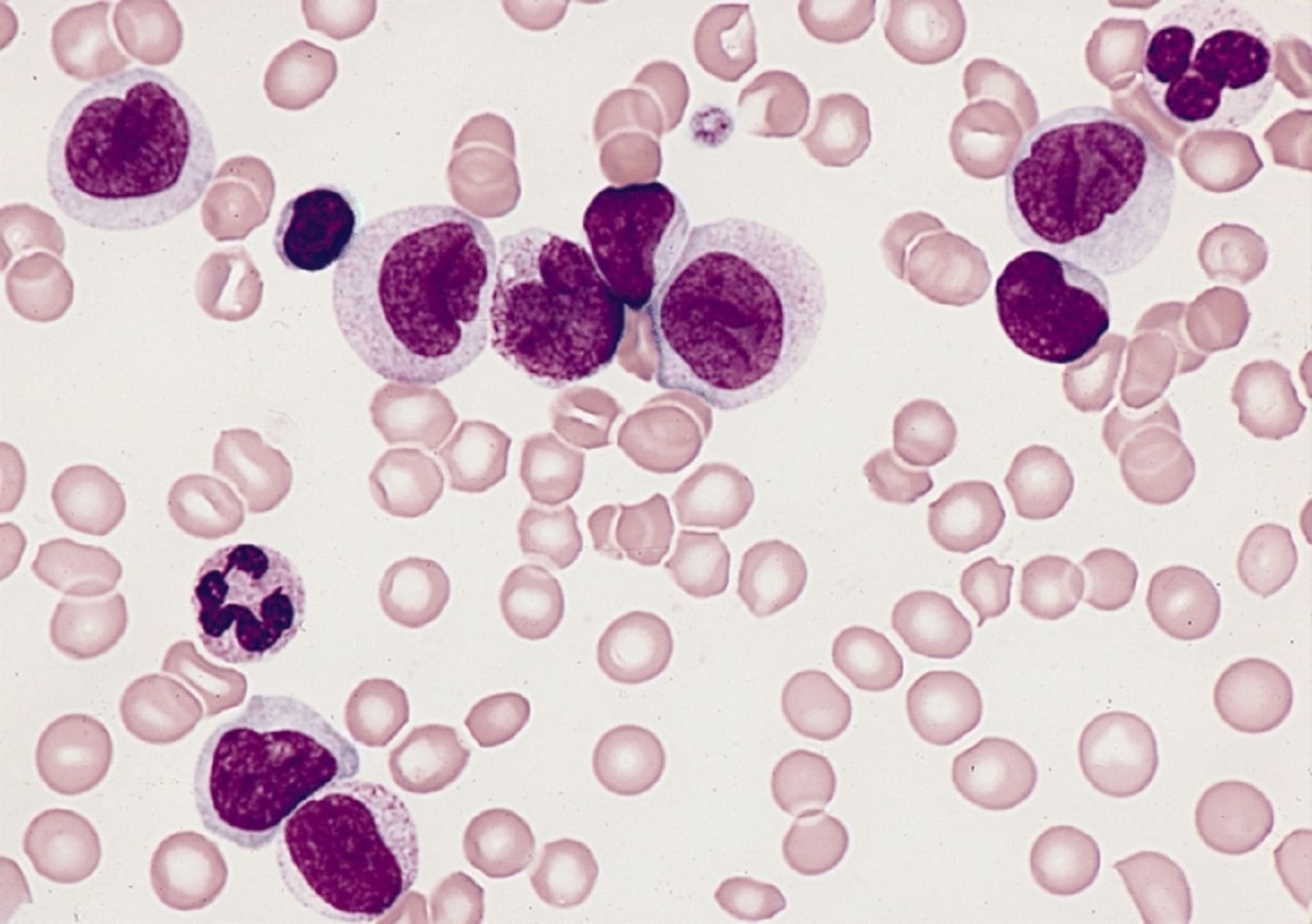 AML: Therapie mit small molecule erfolgreich getestet