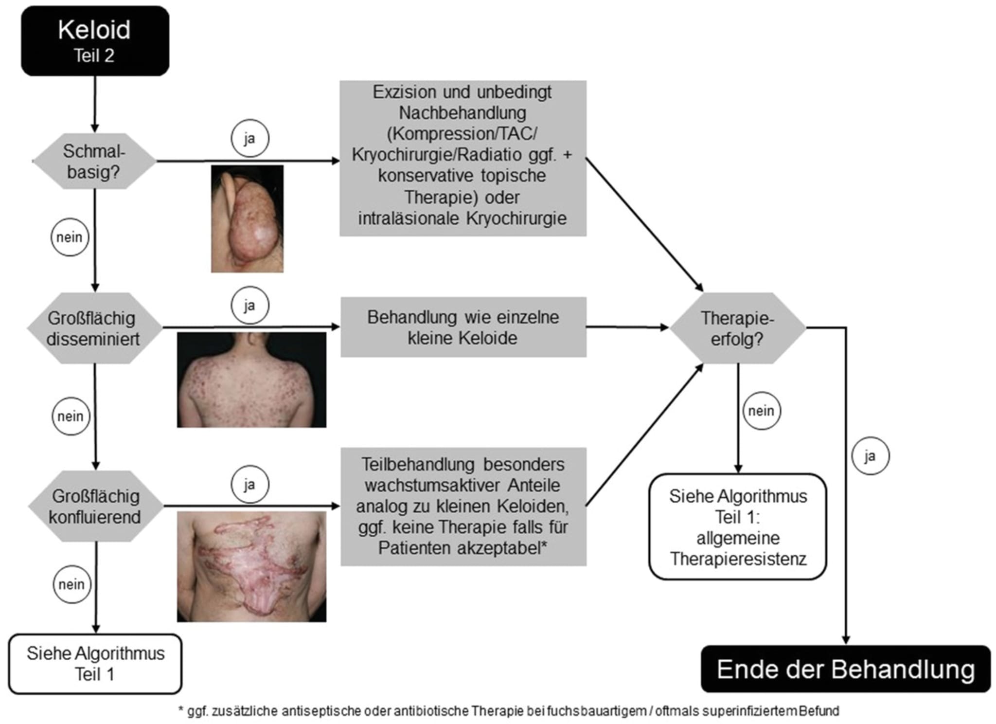 Keloide: Leitliniengerechte Behandlung im Überblick - coliquio