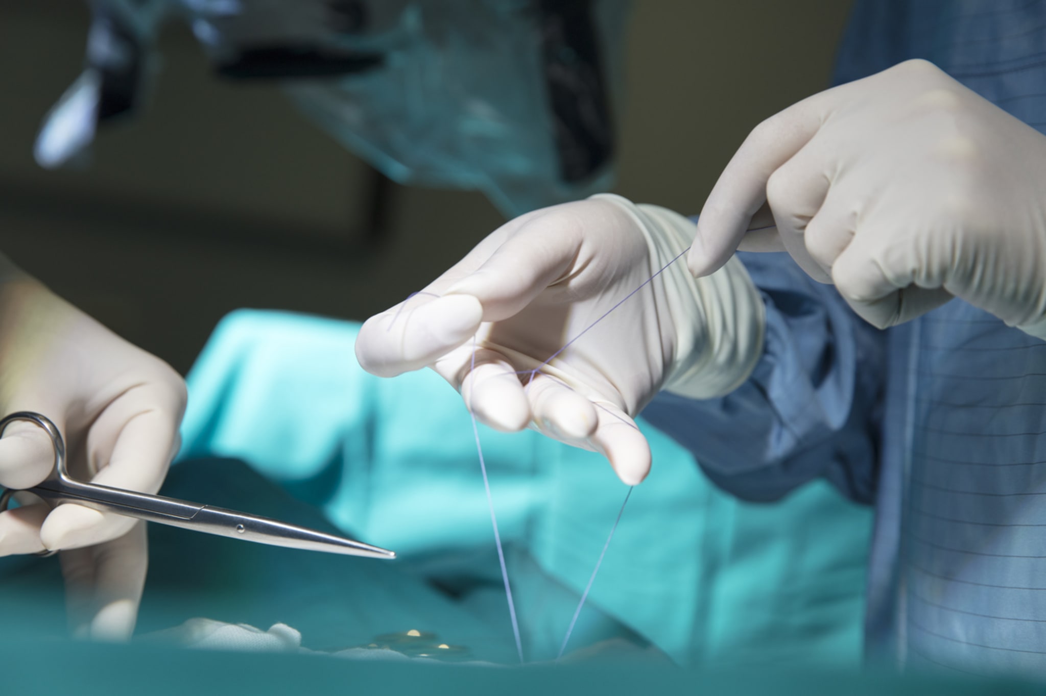 Rektumresektion offen: Alle OP-Details im Überblick