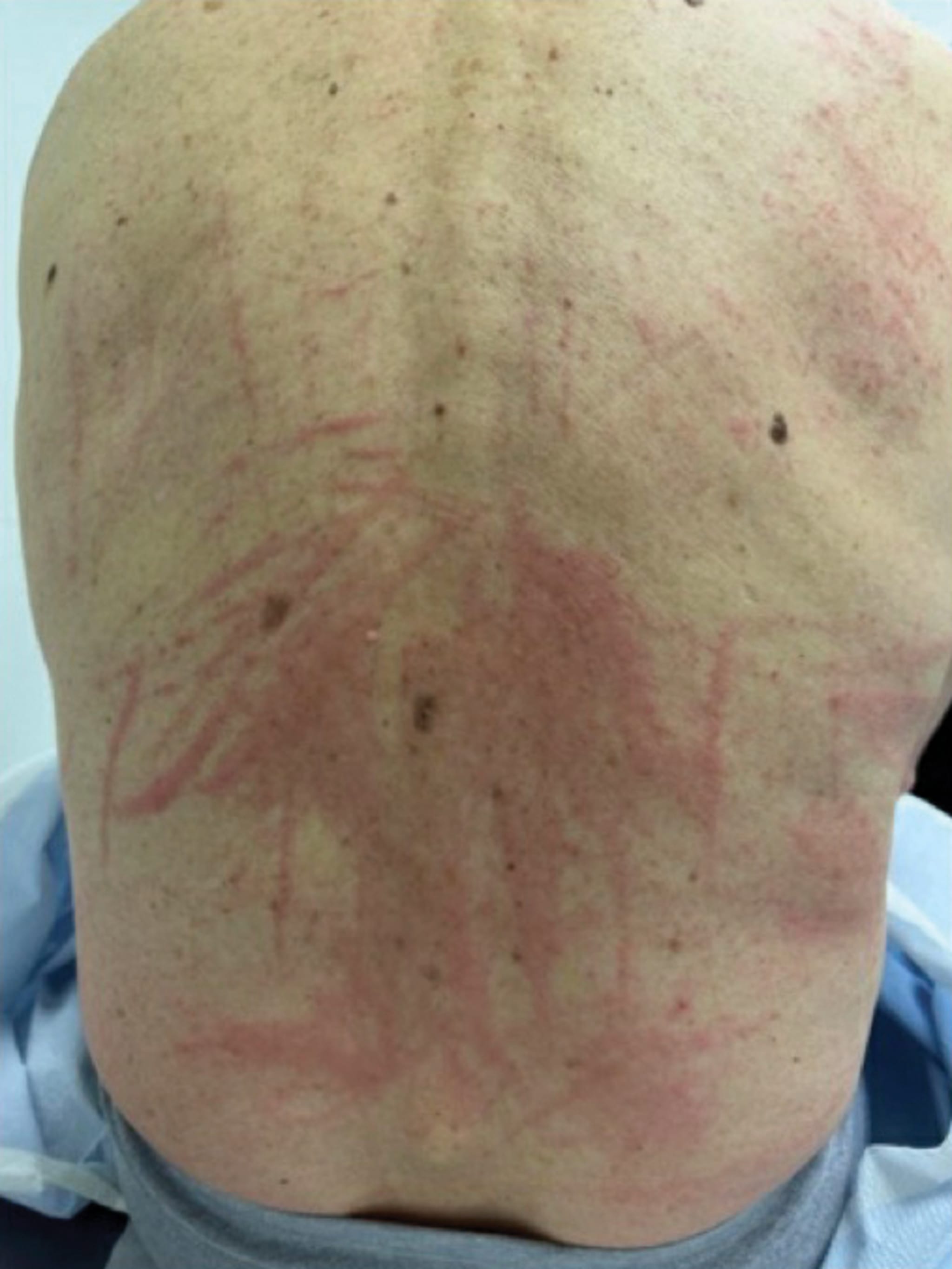 Peitschenspuren auf dem Rücken