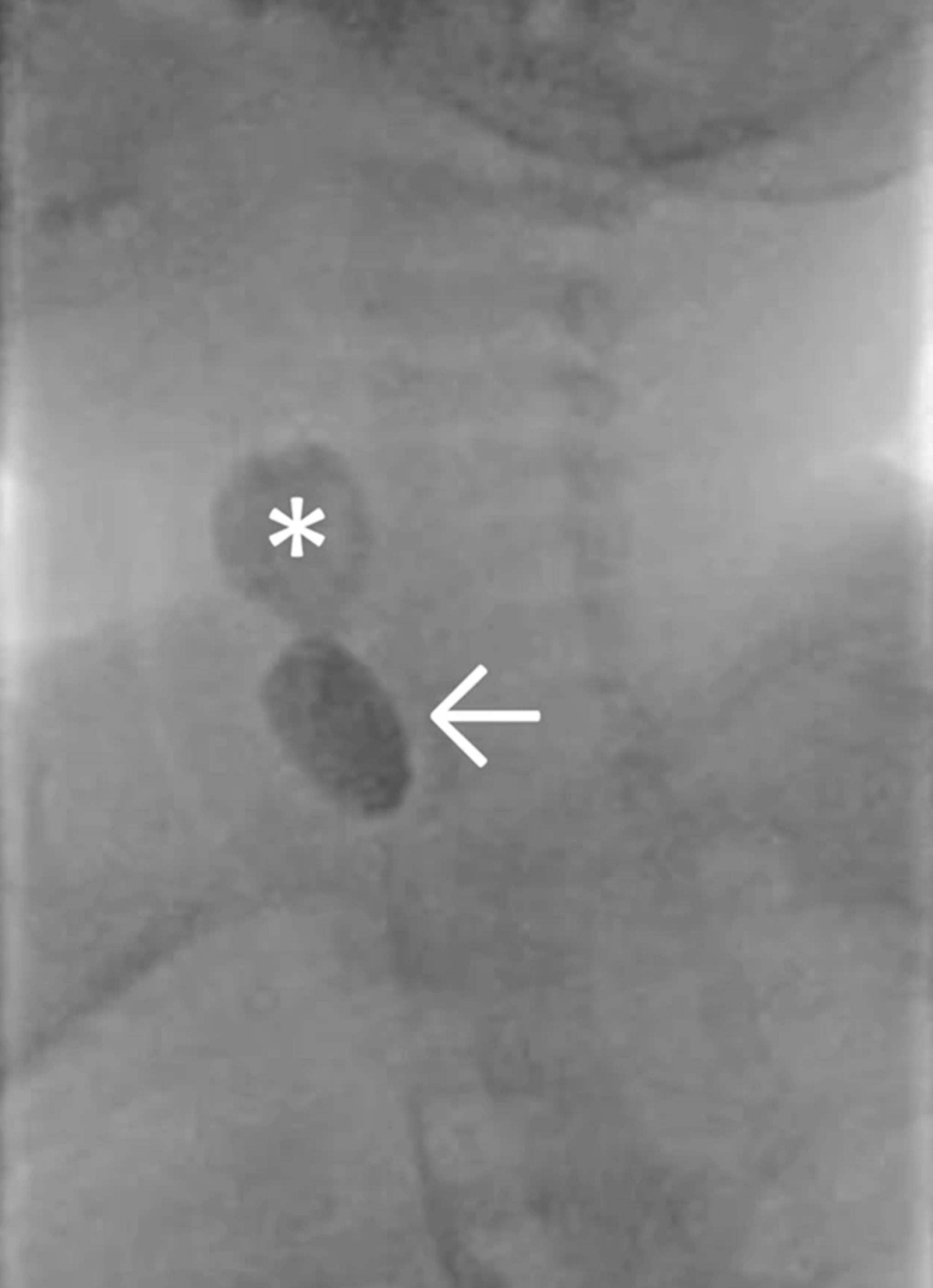 Verschluckte Knopfzellen: Spannung für alle Beteiligten - coliquio