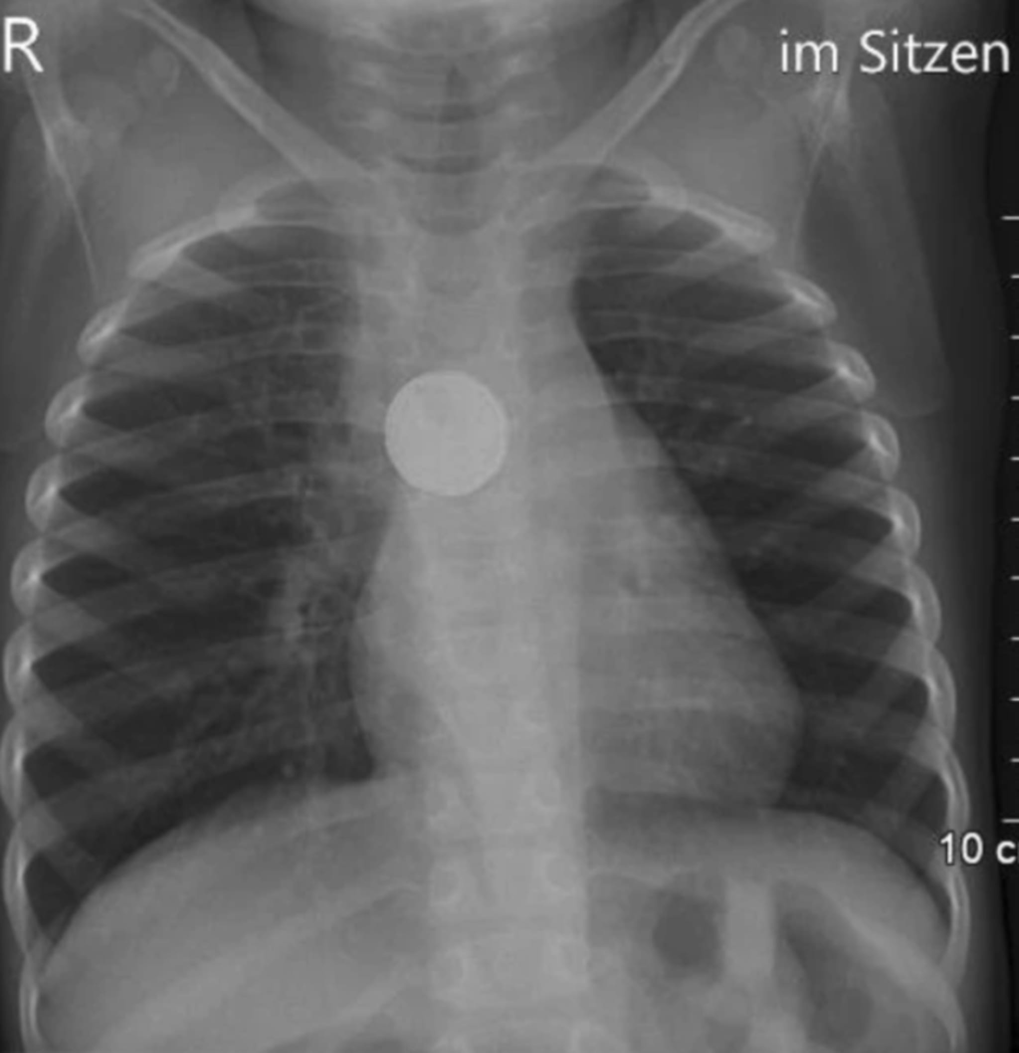 Verschluckte Knopfzellen: Spannung für alle Beteiligten - coliquio