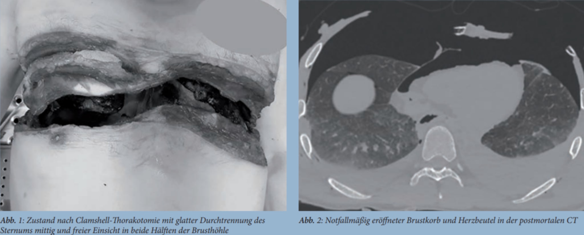 Maximalinvasive Reanimation mittels Clamshell-Thorakotomie - coliquio