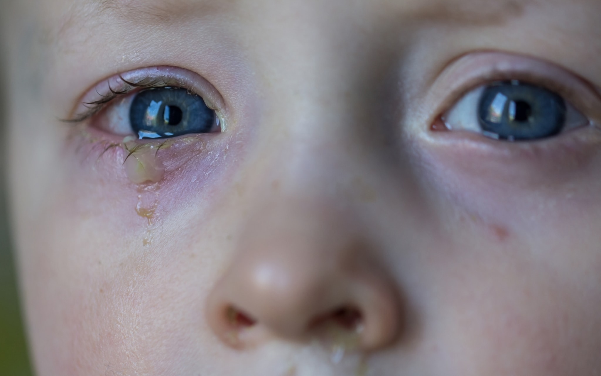 Haut- und Schleimhautreaktionen als Komplikation der Lungenentzündung ...