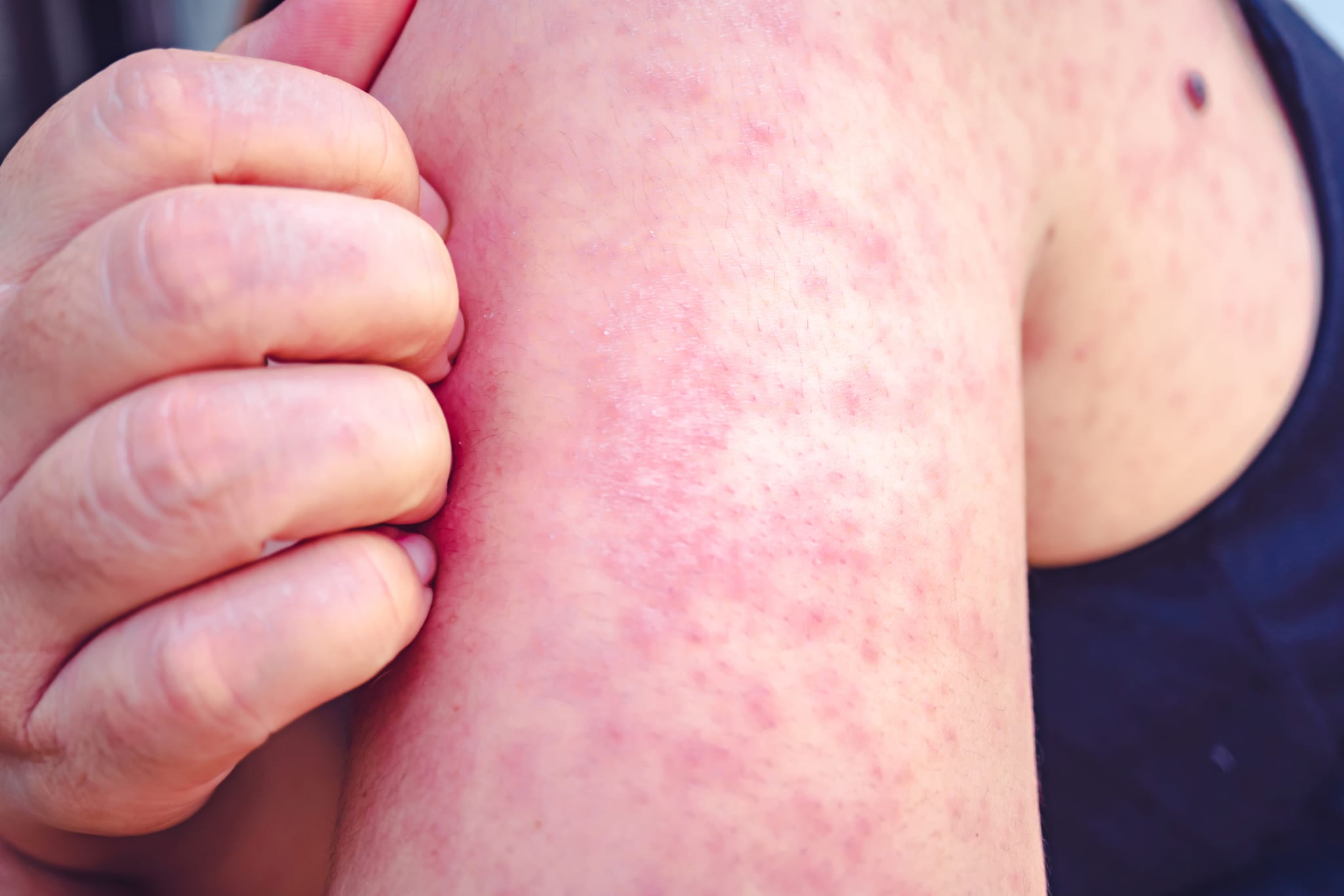 Wie Betroffene eine schwere Prurigo nodularis erleben