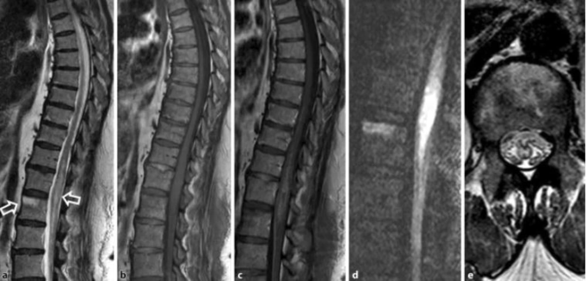 Postoperative Bildgebung der Wirbelsäule - coliquio
