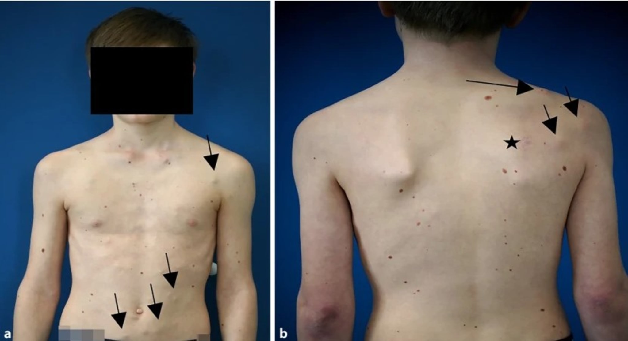 Das juvenile Melanom: Fallbericht und Literaturübersicht