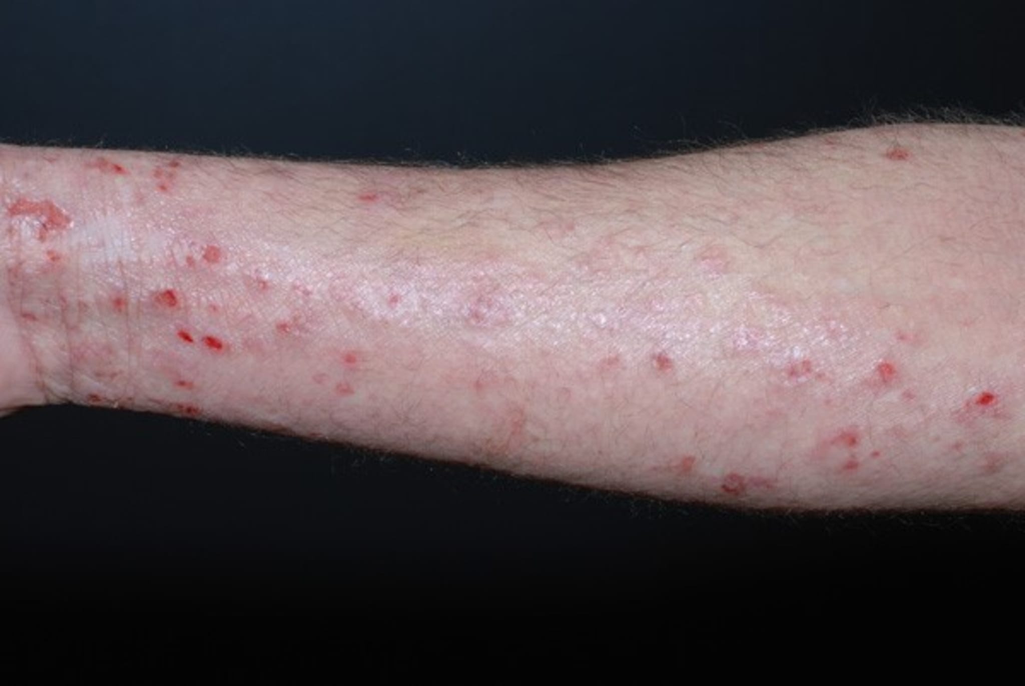 5 häufige Hautkrankheiten: Blickdiagnose & Therapie - coliquio