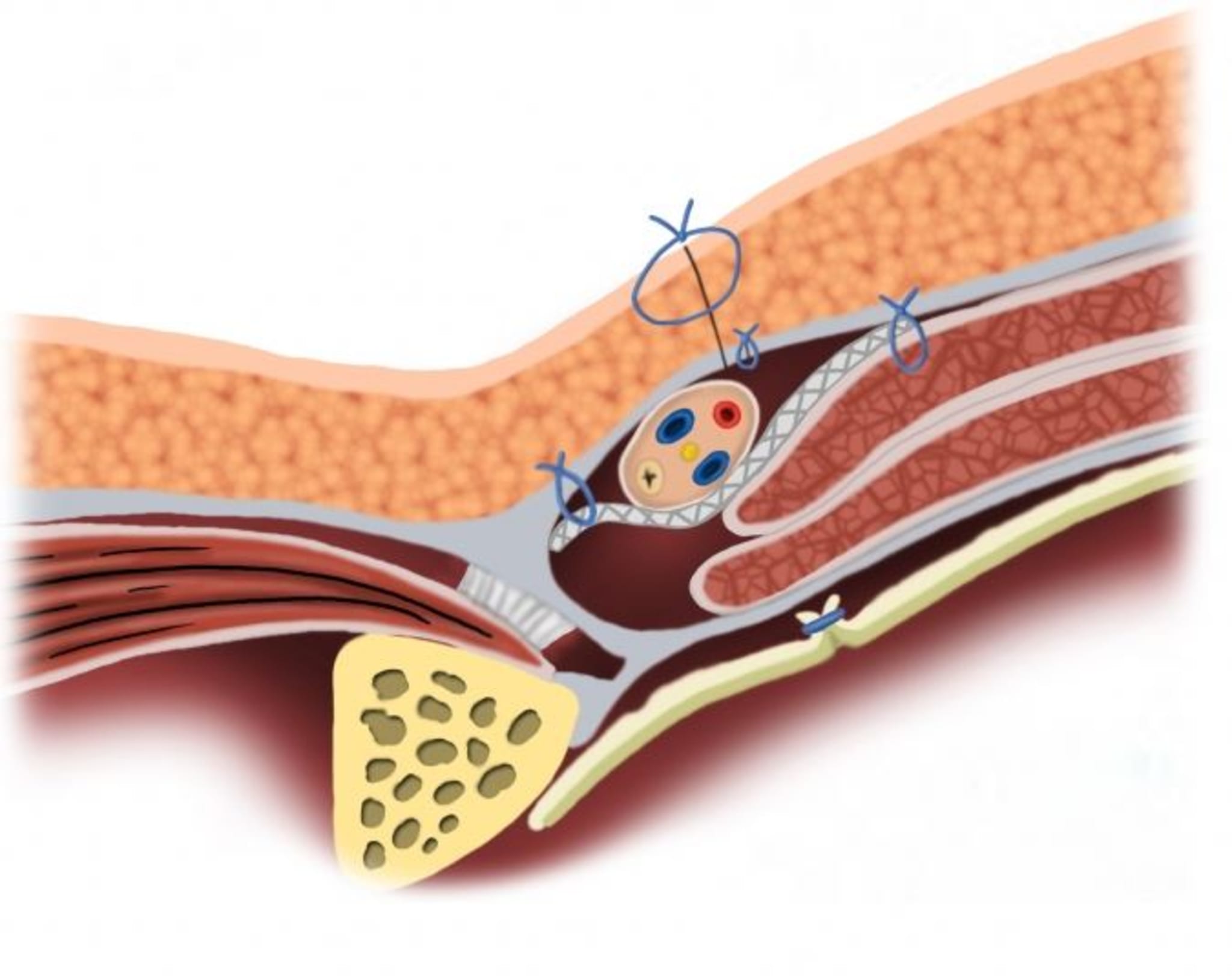 Leistenhernienreparation nach Lichtenstein - coliquio