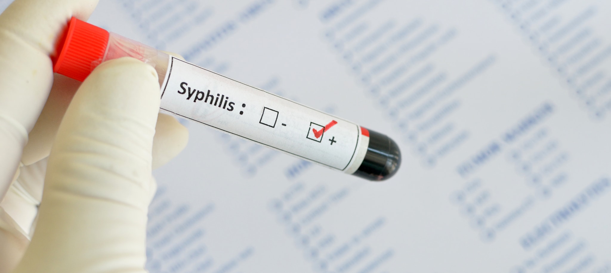 PCR-Tests verbessern Nachweis von Syphilis - coliquio