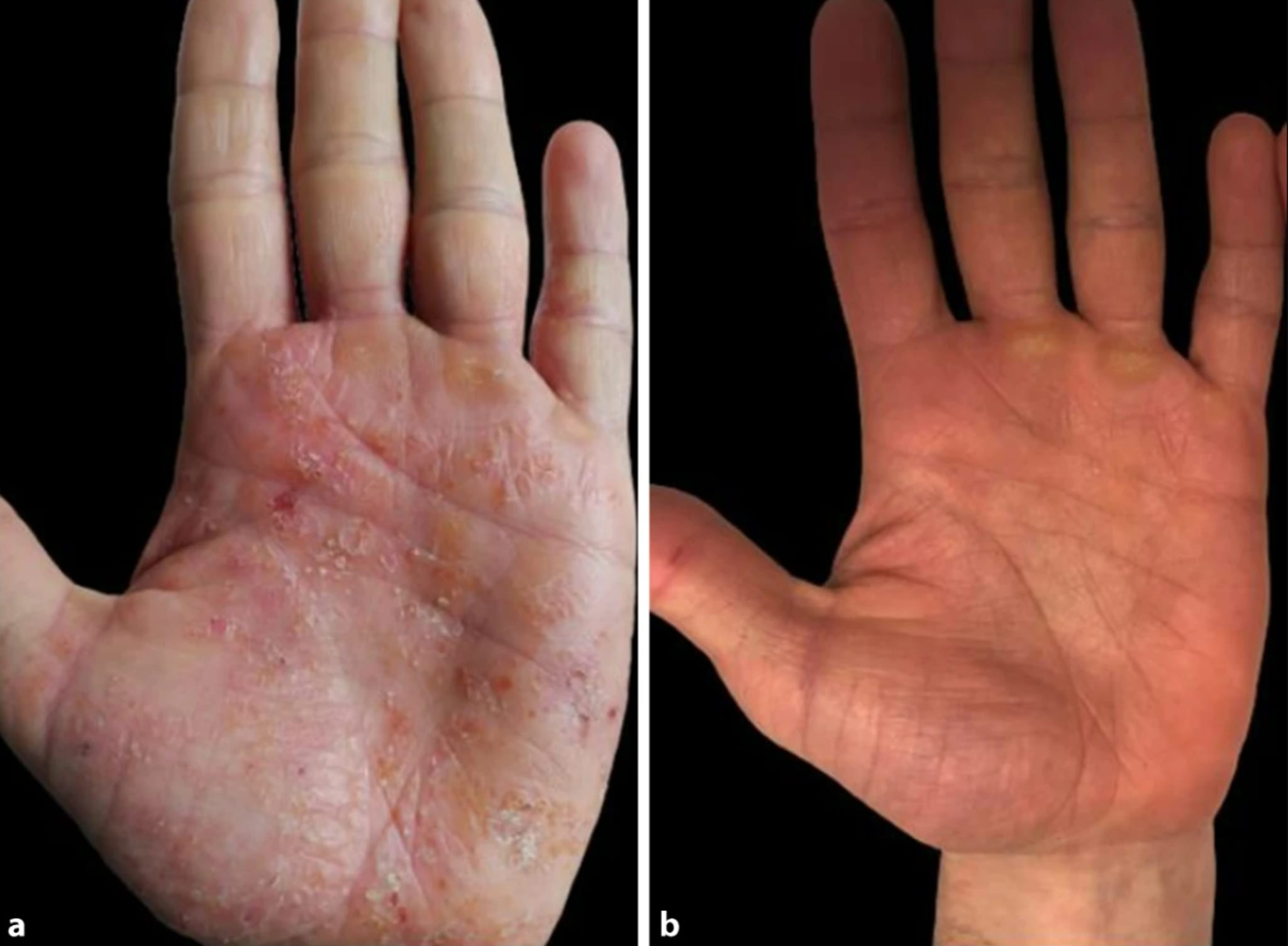 Einschätzungen zur Therapie der moderaten bis schweren atopischen ...