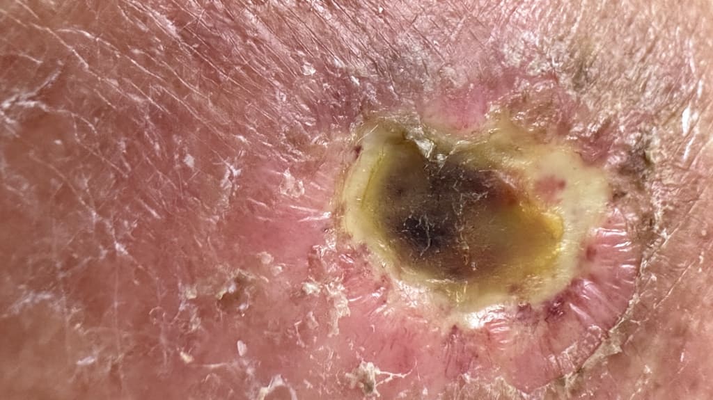 Ulcus Cruris Venosum: Neues zur Diagnostik, Therapie und Leitlinie