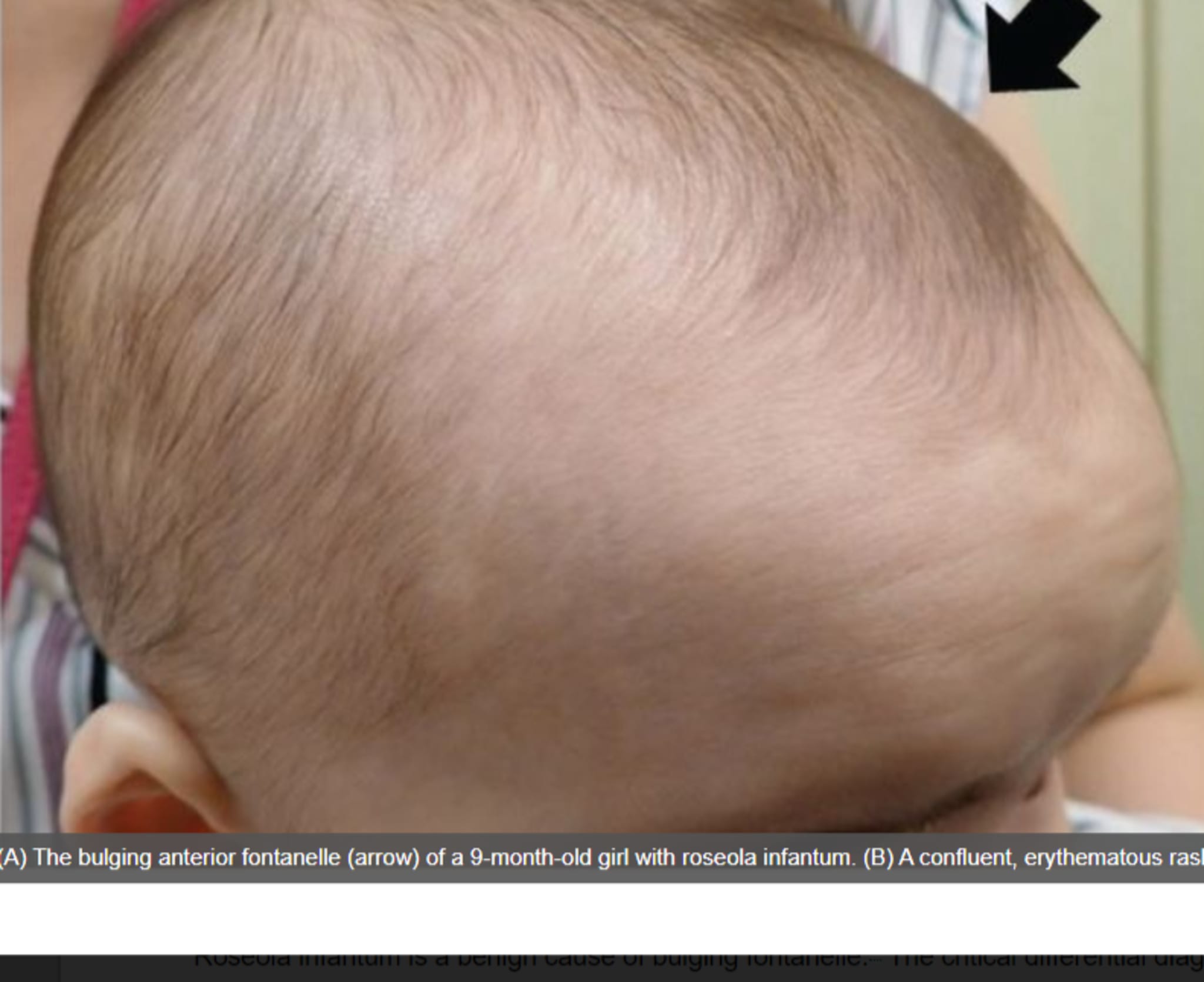 Vorgewölbte Fontanelle