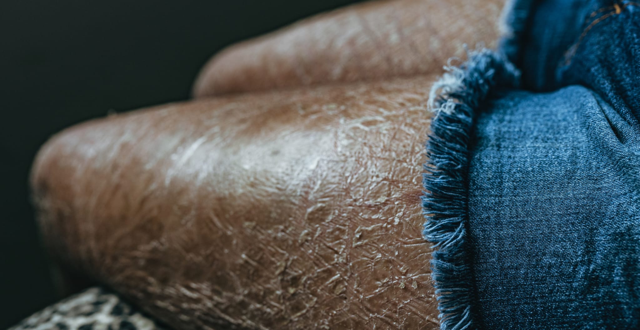 Mangelernährung bei Kindern mit kongenitaler Ichthyose: Wachsam sein ...