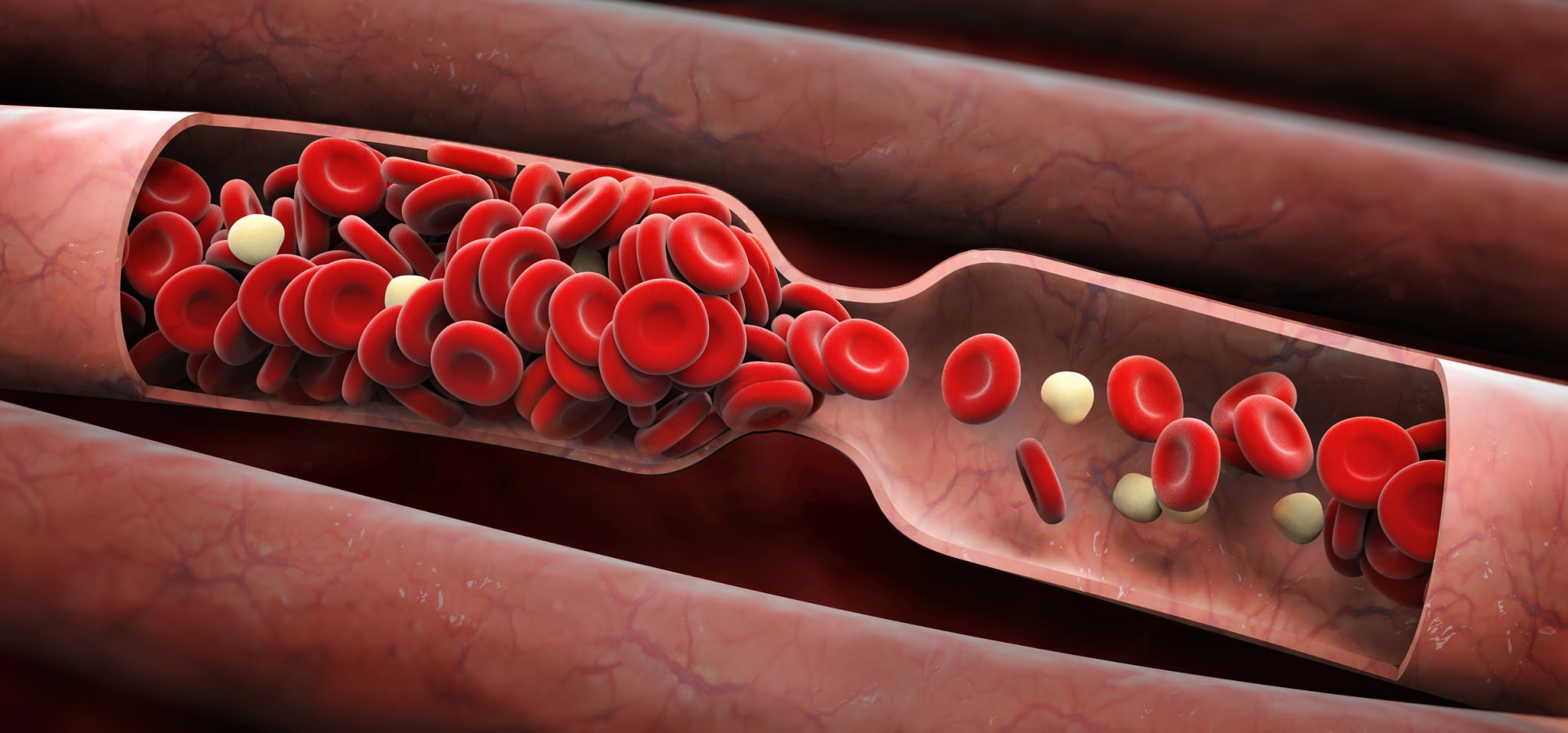 Klinische Merkmale der Impfstoff-assoziierten Thrombosen